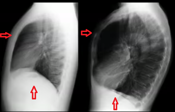 Estudo Radiográfico : COMO IDENTIFICAR UM RX DE TÓRAX ENFISEMATOSO