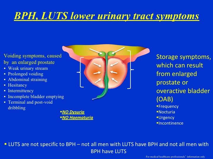 Kuching Urology古晉秘尿專科: Lower urinary tract symptoms LUTS and prostate ...