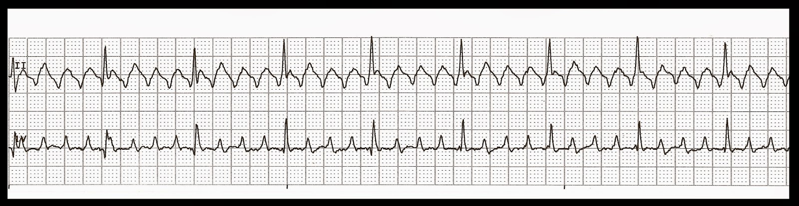 Practice EKG Strips 421