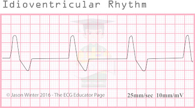 ECG Educator Blog : Ventricular Rhythms
