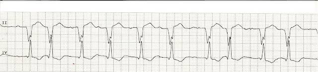 EKG Rhythm Strip Quiz 53: Atrial Rhythms