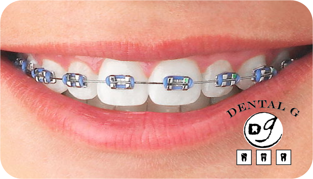 Dental G, Porque Tu Salud y Tu Sonrisa Lo Valen..: Principales Tipos de ...