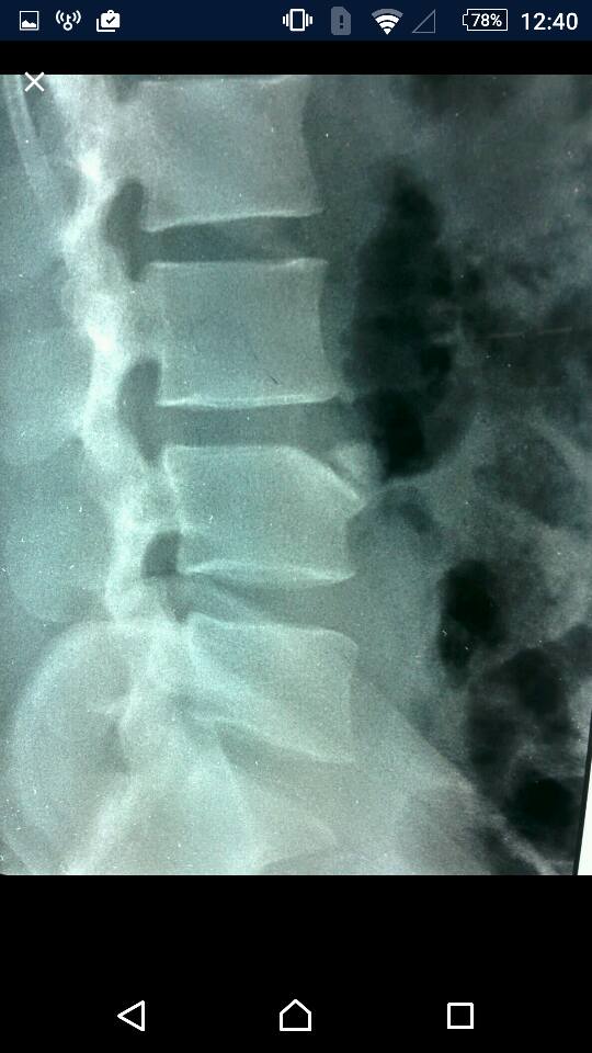 Limbus vertebrae | CĐHA | CHẨN ĐOÁN HÌNH ẢNH