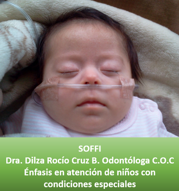 Down Odontología : ¿EL SINDROME DE DOWN SE NOTA EN LA CARA?