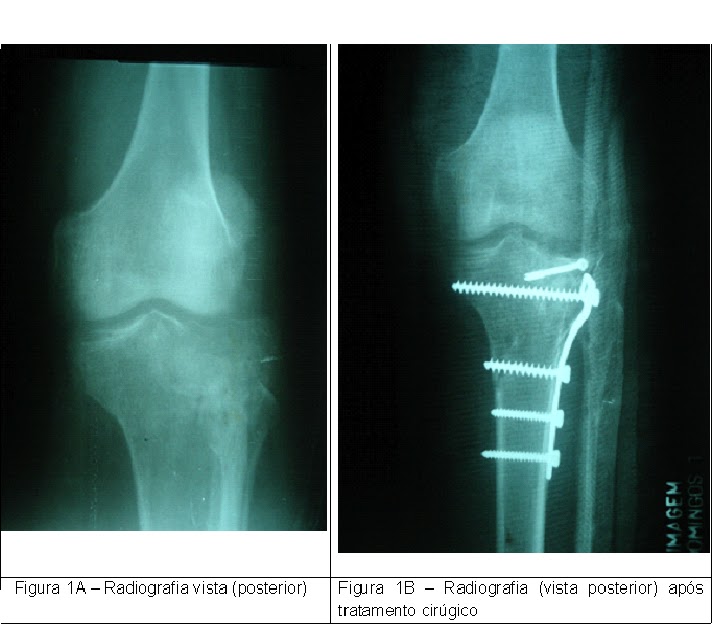 FISIOFACTS: FISIOTERAPIA NO PÓS-OPERATÓRIO DE FRATURA DE PLATÔ TIBIAL ...
