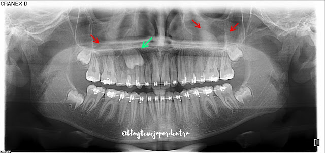 "Te vejo por dentro": Fenômeno de retenção de muco e dente incluso