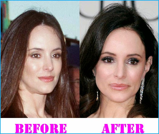 Madeleine Stowe Lip Injections