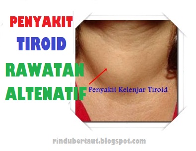 Penyakit Tiroid - Tanda-tanda Penyakit Tiroid dan Rawatan Alternatif ...