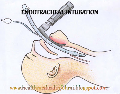 Nawalparasi Helth Worker: Endotracheal Intubation