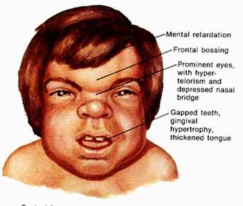 Medical Treatment Pictures-for Better Understanding: Hunter Syndrome