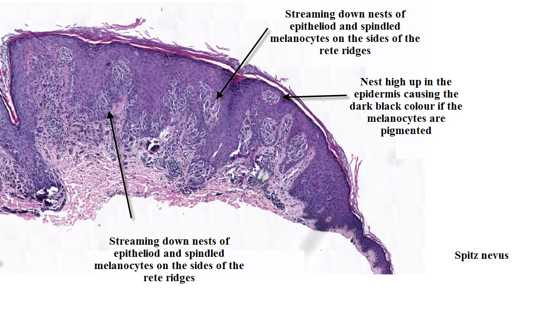 Dermpath Made Simple - Neoplastic: Spitz Nevus and Reed Nevus
