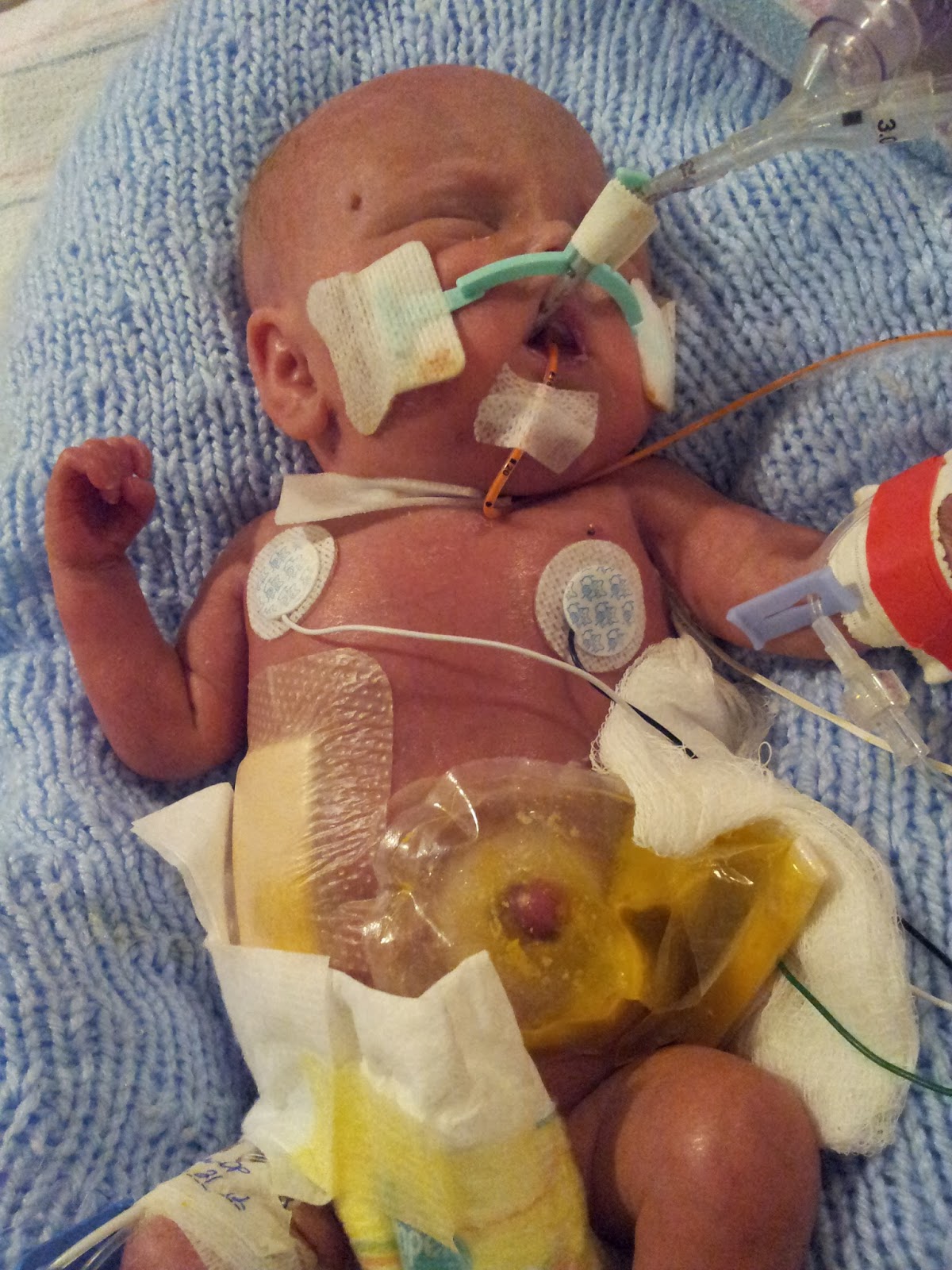 A Three E Circus: Baby Eagan - NICU Day 73