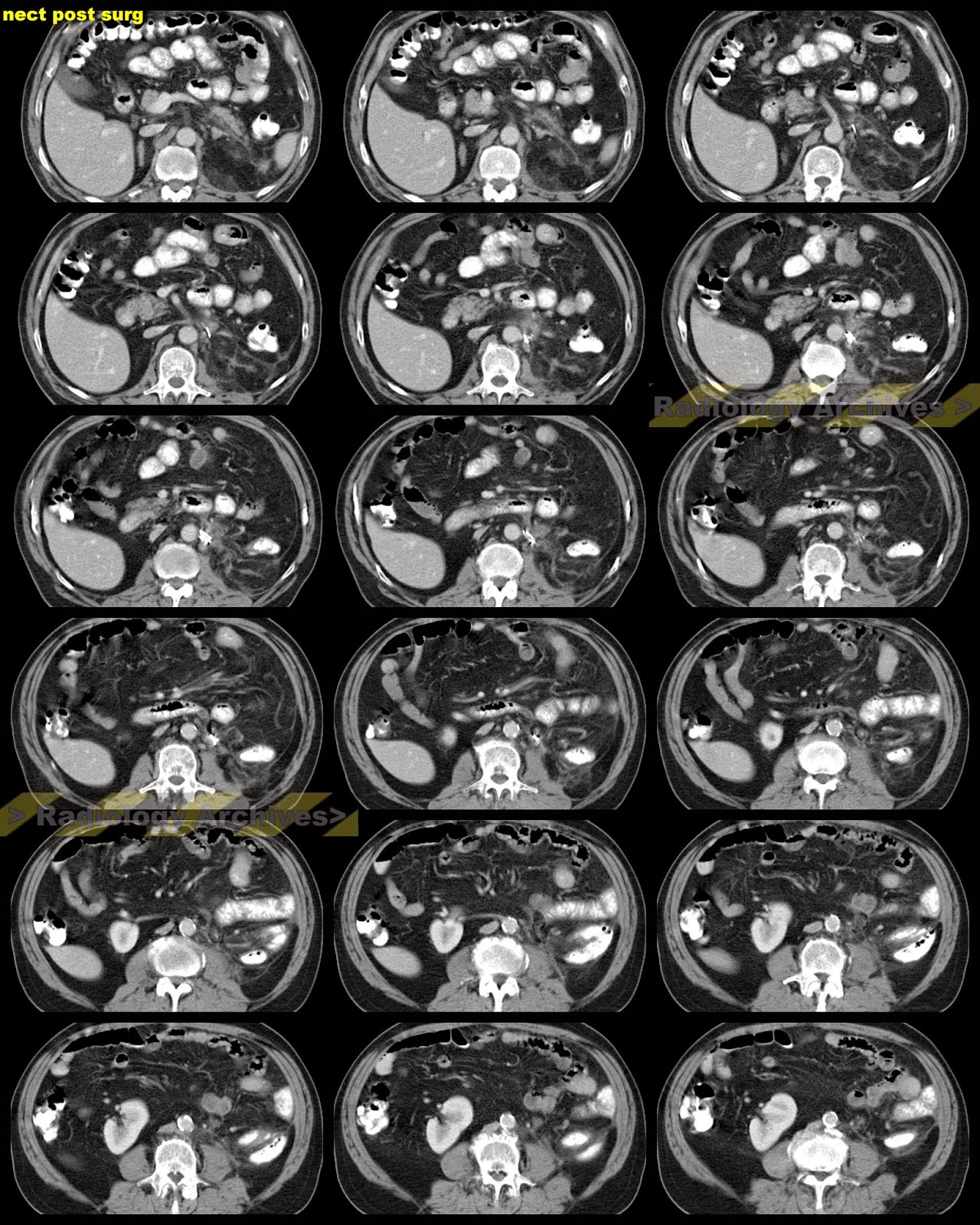 Radiology Archives: Καρκίνωμα εκ Νεφρικών Κυττάρων (Υπερνέφρωμα - Όγκος ...