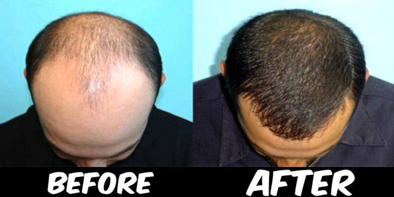 How To Stop Hair Fall For Men, Cure Hair Loss, Cure Baldness - The ...