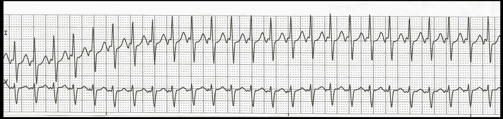 Various Supraventricular Tachycardias