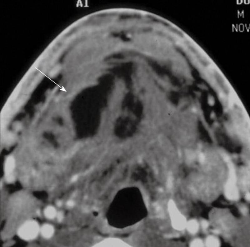 ABC Radiology Blog: Ludwig’s Angina