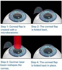Surgery Made Easy: How is Lasik Performed