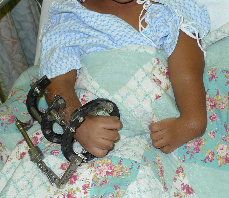Fixator for Radial Longitudinal Deficiency (RLD) | Congenital Hand and ...