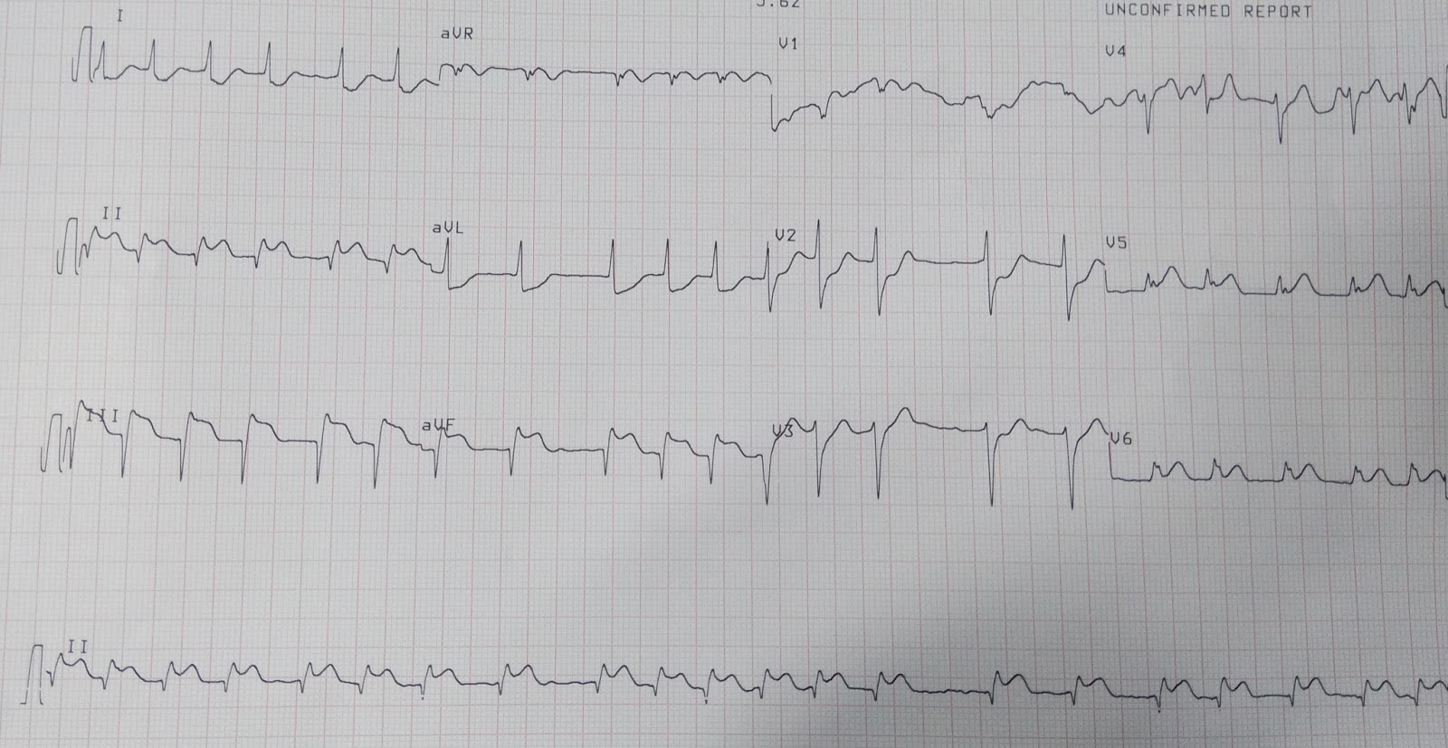 Cardiology window: Atrial fibrillation in a patient with inferior wall ...