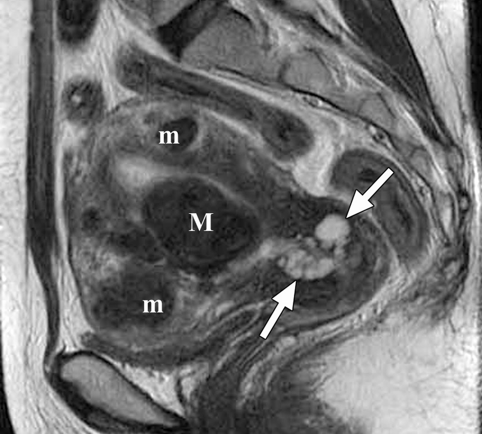 Nabothian Cyst Cause Identification Symptoms Complications Diagnosis Treatment