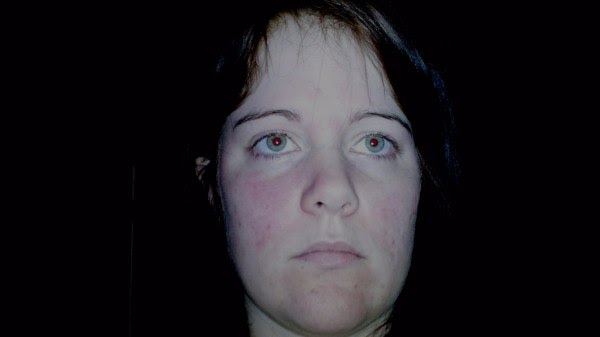 It's Time To Get Over How Fragile You Are: Facial Swelling...Why?