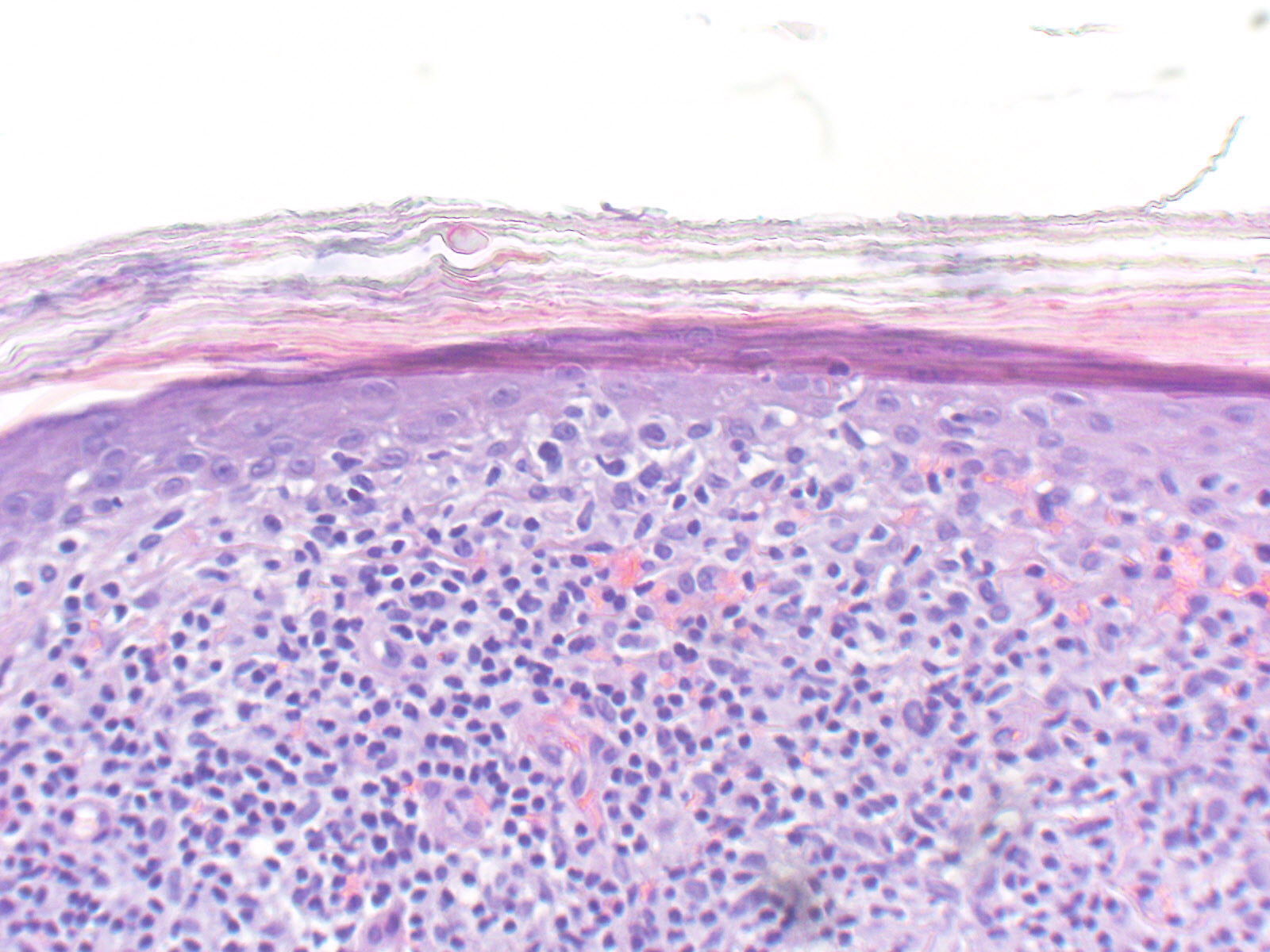 VIRTUAL GRAND ROUNDS IN DERMATOLOGY 2.0: Mycosis Fungoides