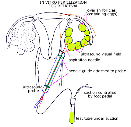 Life, Love, and the Pursuit of a Baby: Egg Retrieval