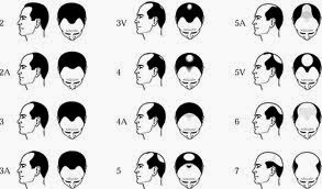 Different Types of Alopecia - Hair Loss