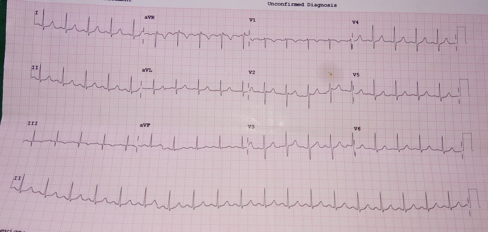 Cardiology window: PSVT (AVNRT)