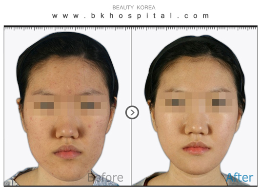 BK Plastic Surgery: [BK Plastic Surgery] Facial Asymmetry Correction