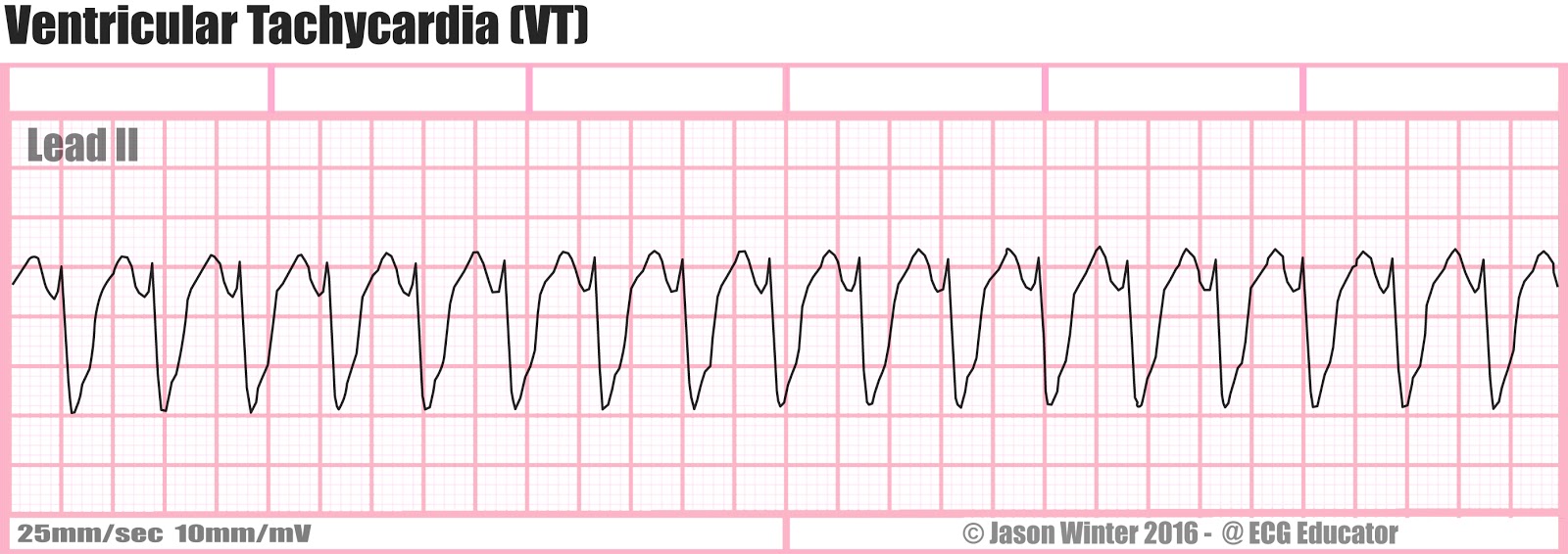 ECG Educator Blog : Six Second ECG Rhythm Strips
