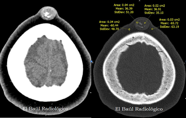 El Baúl Radiológico: OSTEOMAS CRANEALES. (Cranial Osteomas. CT Findings ...