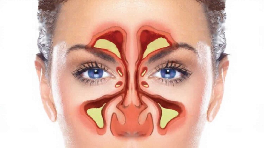 Apa itu Sinusitis, Penyebab Sinusitis, dan Gejala Sinusitis - manfaat ...