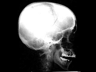 TEKNIK PEMERIKSAAN OS CRANIUM | Kotak Radiologi