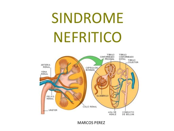 Medical Science: ¿Qué es el Síndrome nefrítico agudo?