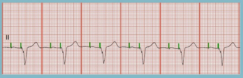 Various Dual Paced Rhythms