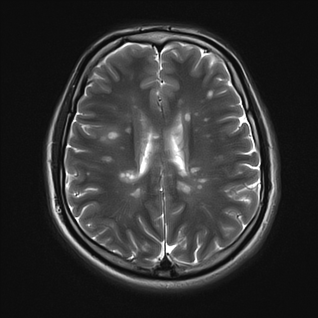 RADYOLOJİ TIBBIN GÖREN GÖZÜ...: MS (MULTIPLE SKLEROZ)
