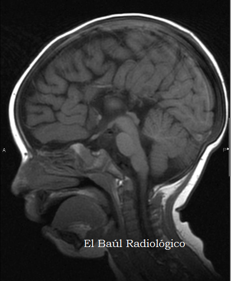 El Baúl Radiológico: AGENESIA DEL CUERPO CALLOSO: HALLAZGOS EN TC e IRM ...