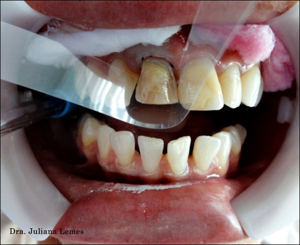 Caso Clínico - Facetas em Resina Composta - OdontoDivas