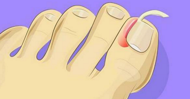 ASÍ DE FÁCIL ES TRATAR LAS UÑAS ENCARNADAS EN CASA