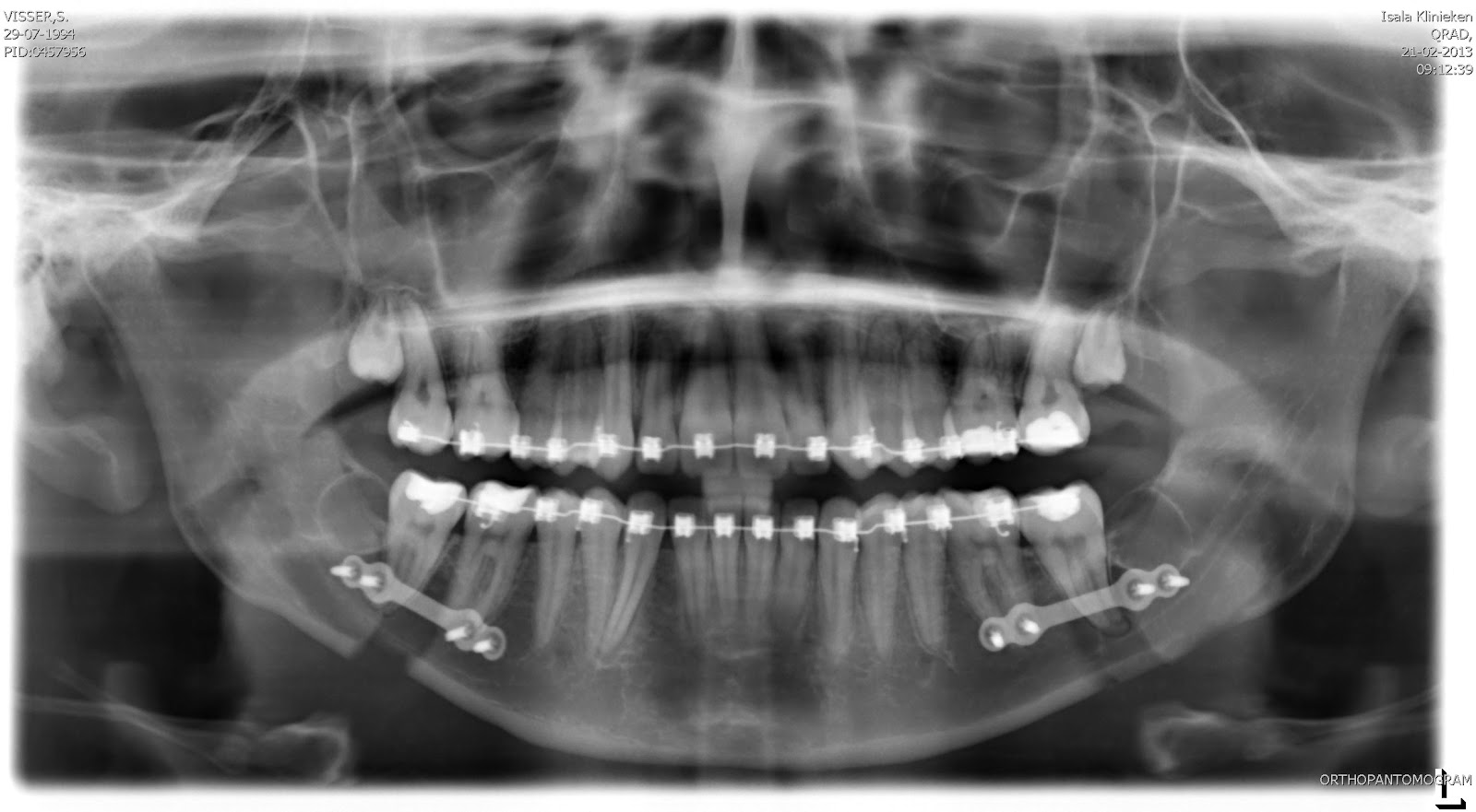 Sharon's kaakoperatie: Röntgenfoto's voor en na de operatie.