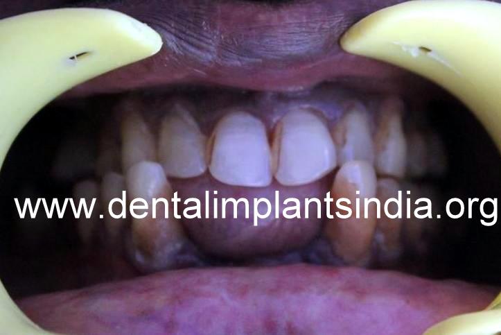 Chinthamani Laser Dental Clinic: REPLACEMENT OF MISSING LOWER FRONT ...