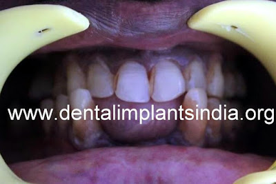 Chinthamani Laser Dental Clinic: REPLACEMENT OF MISSING LOWER FRONT ...