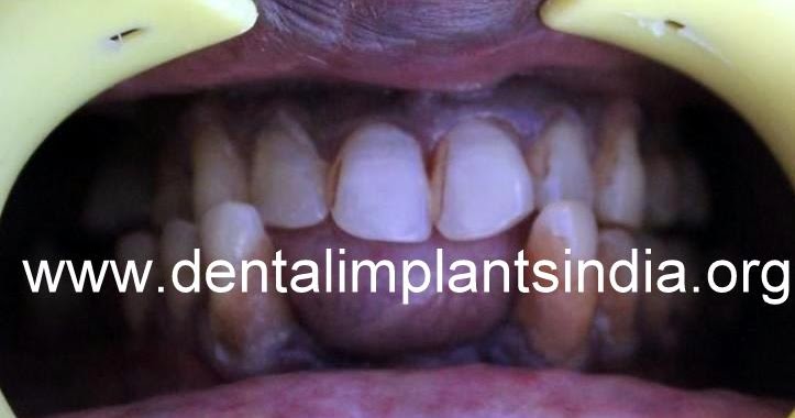 Chinthamani Laser Dental Clinic: REPLACEMENT OF MISSING LOWER FRONT ...