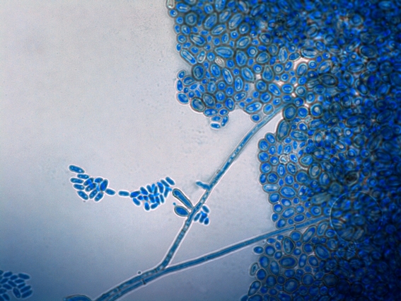 Fun With Microbiology (What's Buggin' You?): Exophiala dermatitidis