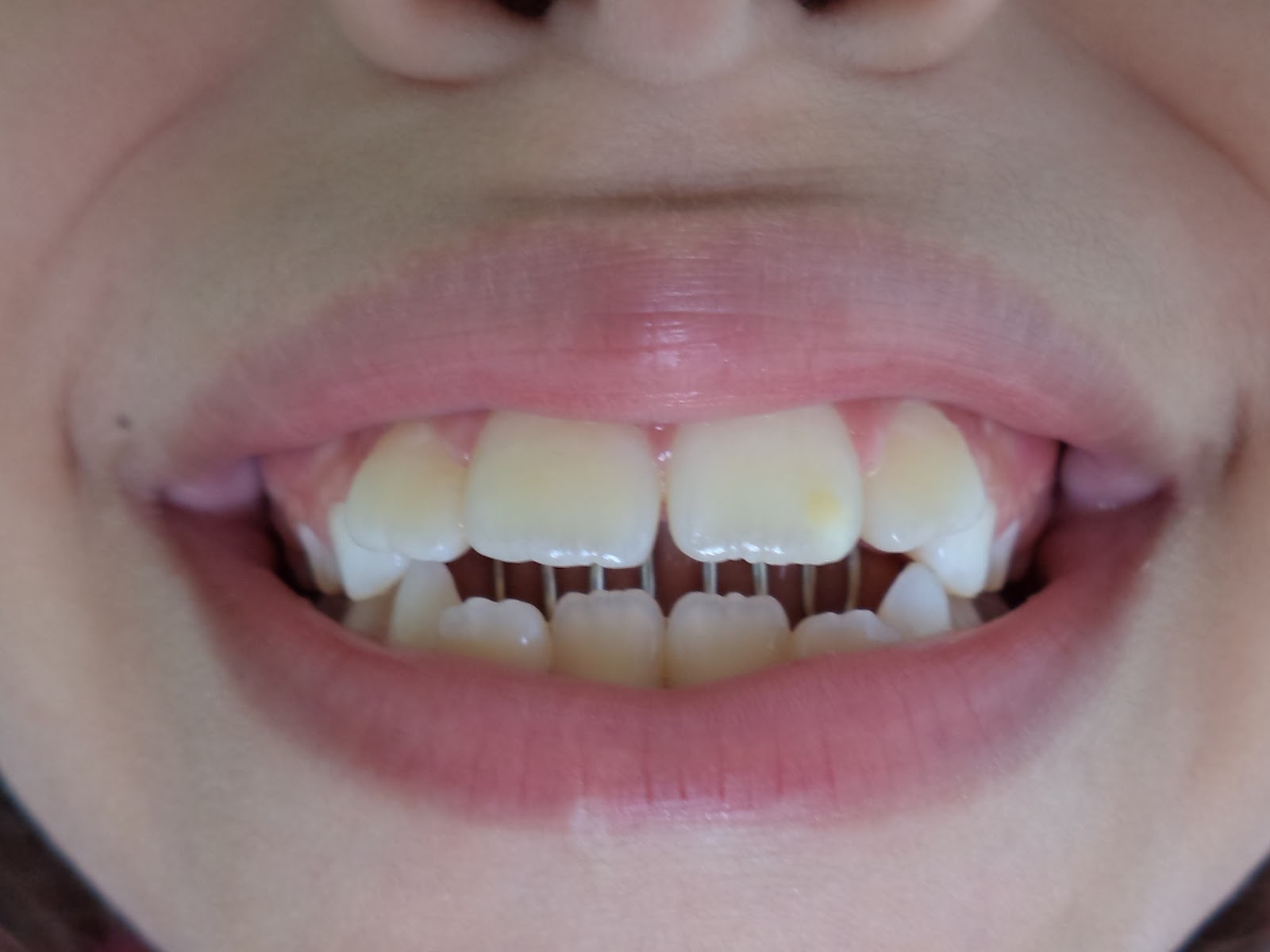 Blog do Dentista: Mordida aberta- atualização Blog do Dentista: Mordida aberta- atualização