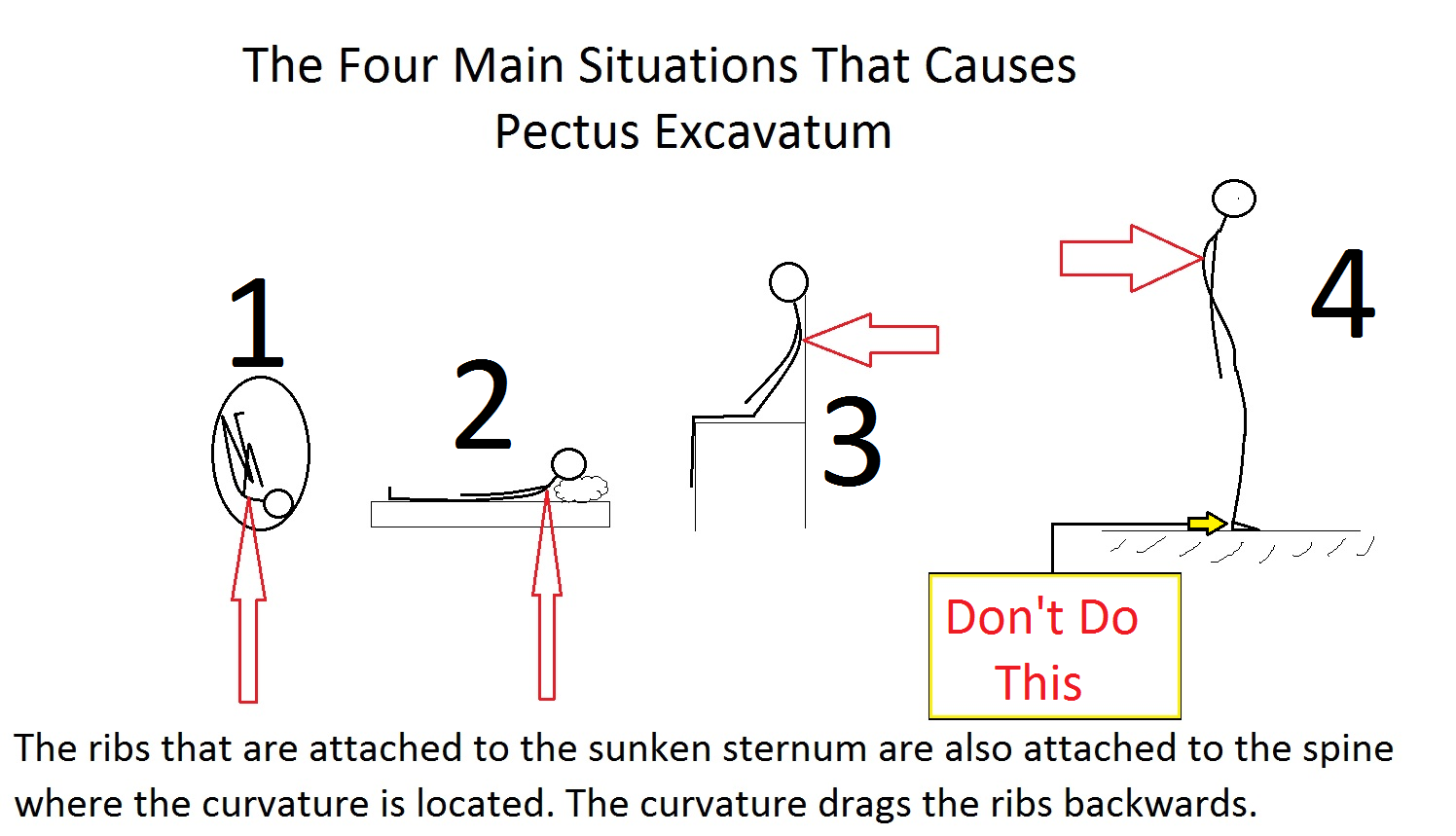 Pectus Excavatum Revolution Blog: How Pectus Excavatum Comes to Exist ...