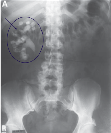 Madrid Urología: Litiasis Urinaria. Pruebas de Imagen.
