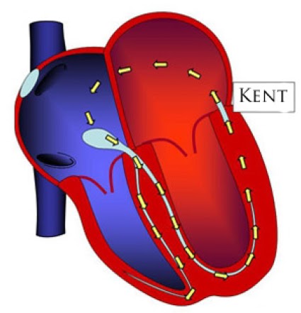 (POKROČILÍ) AVNRT versus AVRT - Kardioblog