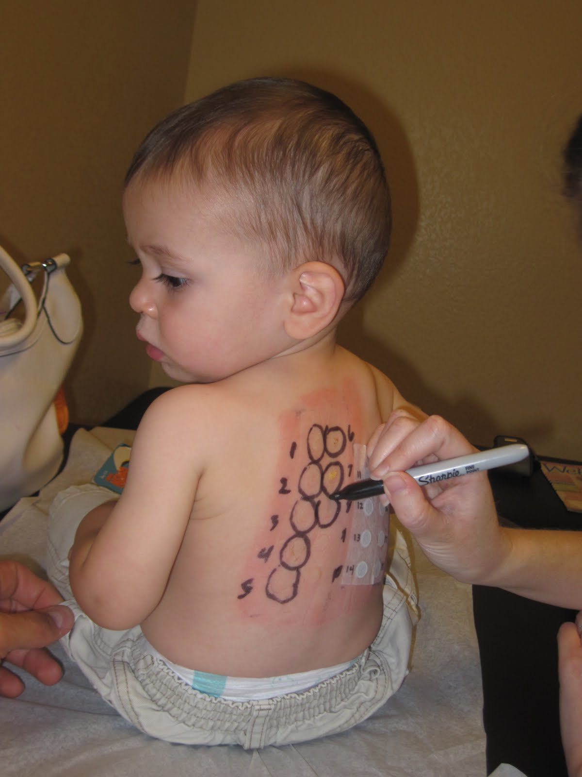 Tyler C with EE: Patch Test Results